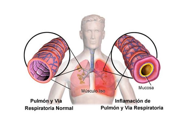La Bronquitis - Sitio Web