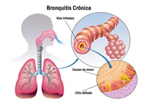 Qué es la bronquitis crónica: Todo lo que debes saber [ 2025 ]
